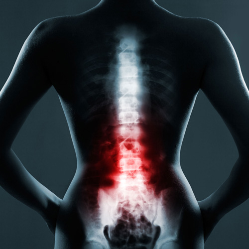 Discogenic Pain – Colorado Interventional Health Sciences
